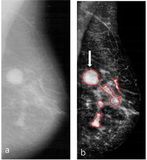 Kanker Payudara Patofisiologi Diagnosis Penatalaksanaan Alomedika