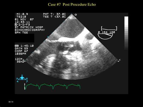 Ppt Trileaflet Aortic Valve Powerpoint Presentation Free Download Id 6983750