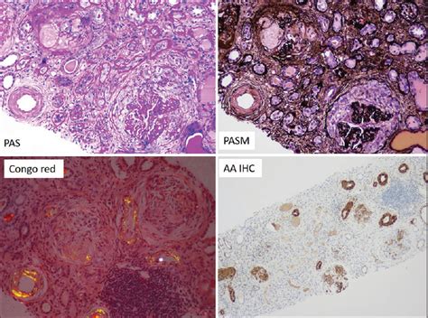 Aa Amyloidosis Presenting As Crescentic Glomerulonephritis Indian