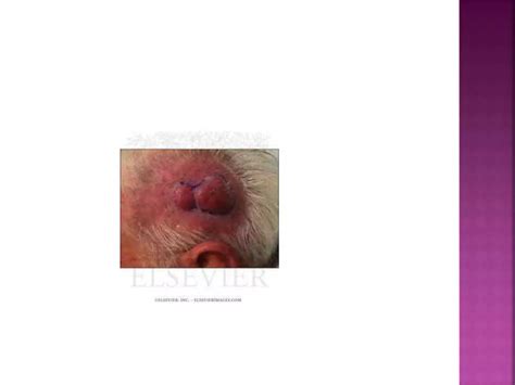 Soft Tissue Sarcomaspptx