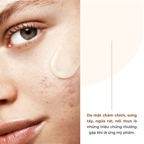 Cần Làm Gì Khi Da Bị Dị ứng Mỹ Phẩm Bỏ Qua 4 Lưu ý Này Sẽ Khiến Da Lão Hóa Không Phanh”