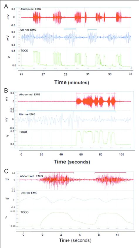 Representative Tracings Of Abdominal Uterine And Toco During The