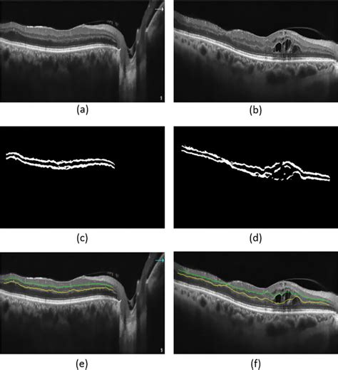 Segmentation Results Using Cubic Spline Interpolation A An Oct Slab
