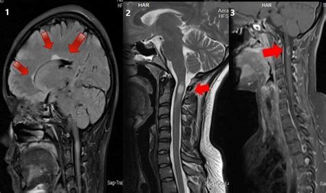 Cervical Spine Mri Comparison Contrast Enhanced T1 Weighted Head And
