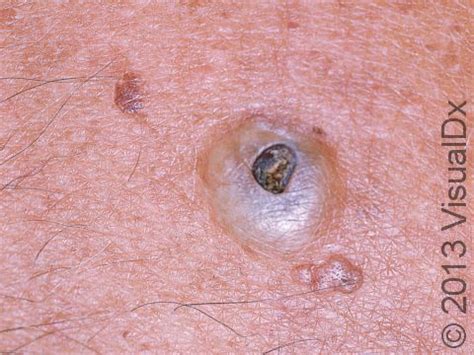 Infected Cyst Epidermoid Cysts Diagnosis Causes And Treatment