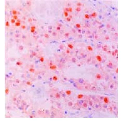 Case No 3 The Tumor Cells Are Fusiform With Abundant Basophilic
