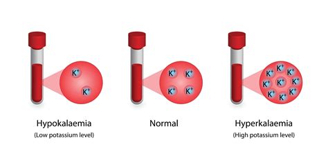 Approach To Hyperkalemia The Art Of Clinical Medicine