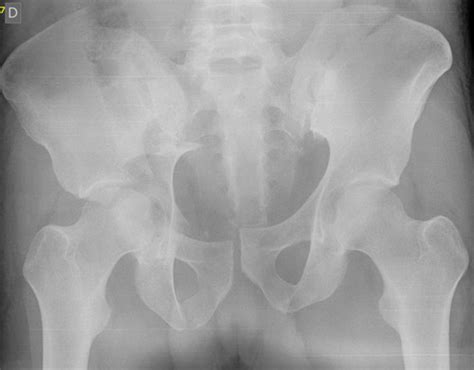 Management Of A Complex Pelvic Fracture In A Year Old Man Practical Course Orthopedics