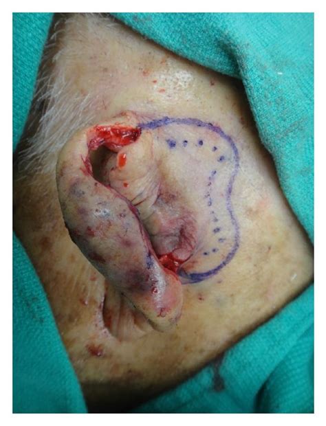The Defect Served As A Stencil On The Postauricular Skin To Create The Download Scientific