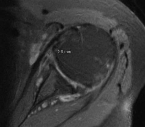 The Association Between Anterior Shoulder Joint Capsule Thickening And