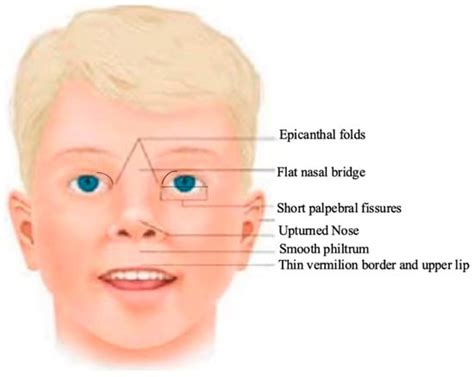 Clinical Diagnosis And Management Of Fetal Alcohol Spectrum Disorder