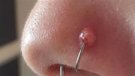 How To Get Rid Of Nose Piercing Scar Tissue Youtube