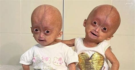 Twins Born With A Rare Benjamin Button Syndrome What Does The Sisters Look Like