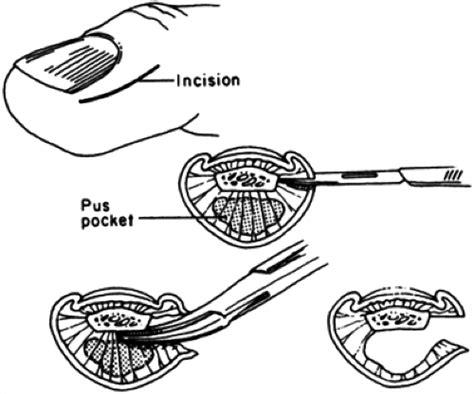 Infections Musculoskeletal Key