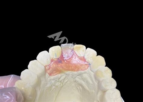 Nesbit Flexible Partial Denture For Incisors Offering A Seamless