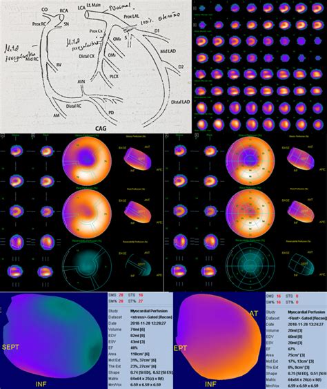 A 45 Years Old Non Diabetic Male Sp Treatment For Nstemi With Cag