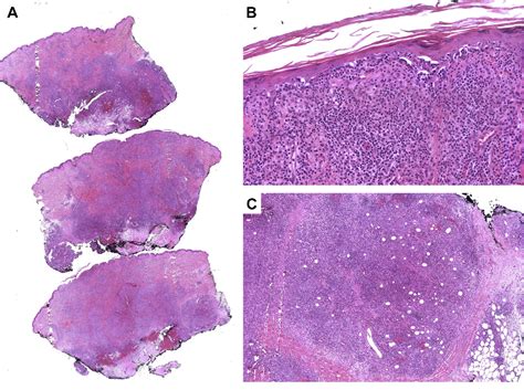 Figure 4 From Cutaneous Lymphomas With Cytotoxic Phenotype Semantic