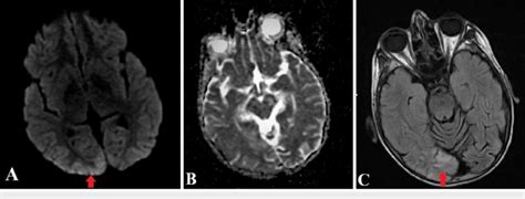 Mri Sequences Show Restricted Diffusion On Dwi A In The Right Download Scientific Diagram
