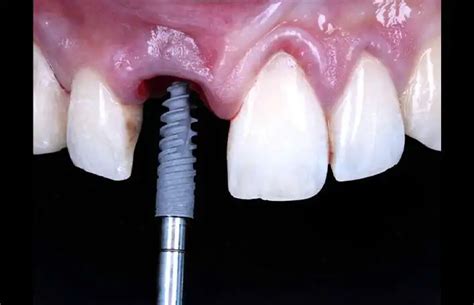 Immediate Loading Implantology In Albania Dr Roland Zhuka