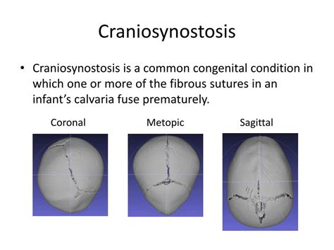 Ppt Classification And Feature Selection For Craniosynostosis