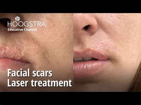Facial Craters Facial Scars Can Be Removed Permanently Medicine