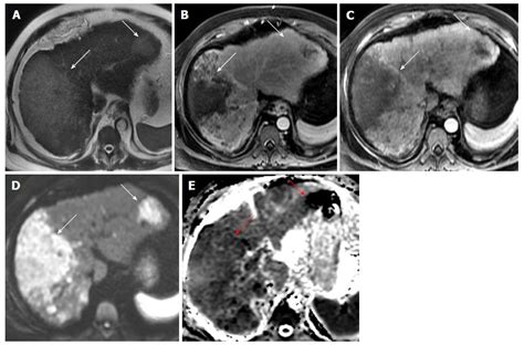 Diffusion Weighted Magnetic Resonance Imaging Of Liver Principles