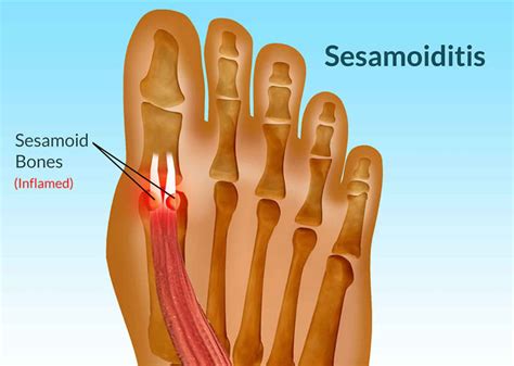 What Is Sesamoiditis And How Can I Fix It Southwest Foot And Ankle