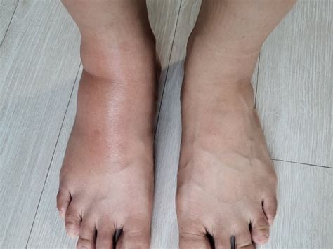 벌레 물리고 깁스한썰 봉와직염연부조직염모기물린데부음 네이버 블로그