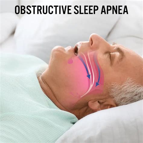 Obstructive Sleep Apnea And Stroke Risks Diagnosis And Prevention