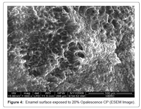 Effect Of Three Bleaching Agent On Surface Roughness Of Enamel I
