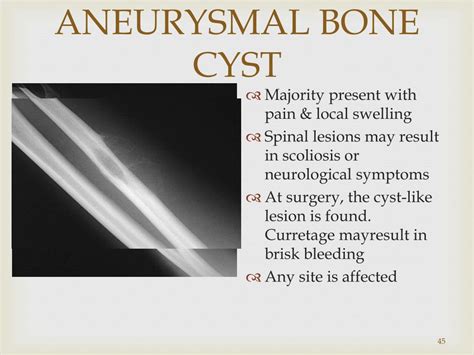Ppt Primary Bone Tumors Powerpoint Presentation Free Download Id1546366