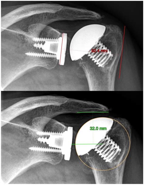 Clinical And Radiologic Outcomes After Anatomical Total Shoulder
