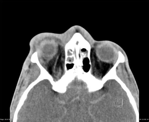 Preseptal Cellulitis Vs Orbital Cellulitis