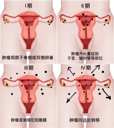 一文教你如何看卵巢癌的分期 知乎