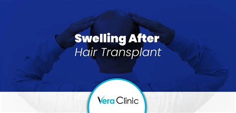 Swelling After Hair Transplant Vera Clinic