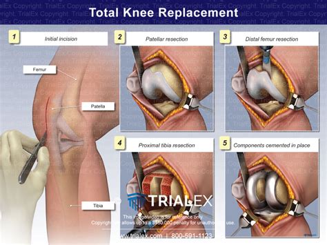 Total Knee Replacement Trialquest Inc