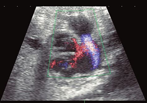 This Image Shows Right Ventricular Hypertrophy Subaortic Ventricular