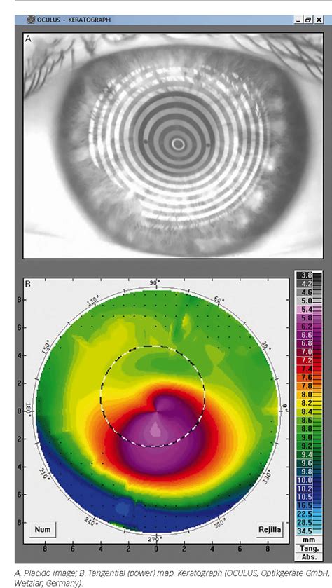 Figure 1 From Keratoconus Screening In Primary Eye Care A General Overview Semantic Scholar