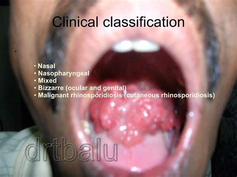 Rhinosporidiosis Ppt