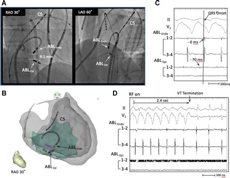 A B Bipolar Radiofrequency Rf Catheter Ablation Was Performed Download Scientific Diagram