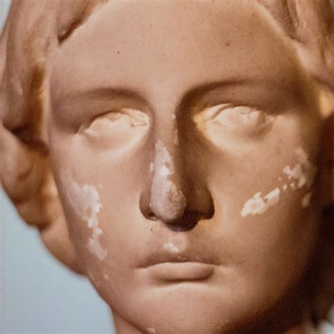 Achromic Nevus Dr Breslavets Cmsd