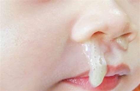 Mengenal Beberapa Penyebab Yang Membuat Ingus Berwarna Kuning Begini Penjelasannya Menurut Dokter