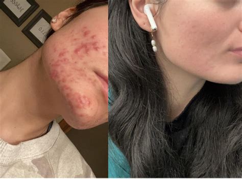 10 Days Left Of My Accutane Journey Mg 6080100100100100 Raccutane