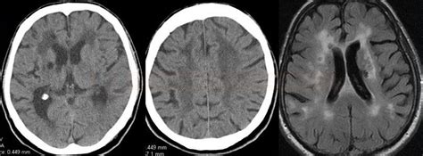 Binswangers Disease Stroke Manual