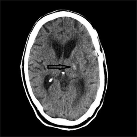 Thalamic Hemorrhage Prognosis At Malik Keck Blog