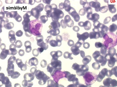 Dacryocyte Comprendre Son Importance Dans Le Diagnostic Des Maladies Hématologiques Eln