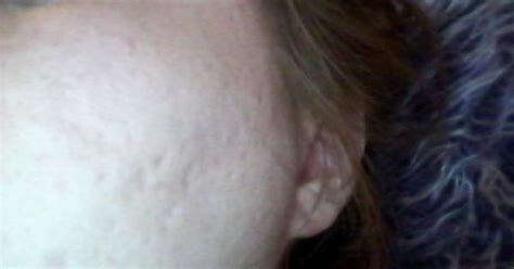 Acne Progress Album On Imgur