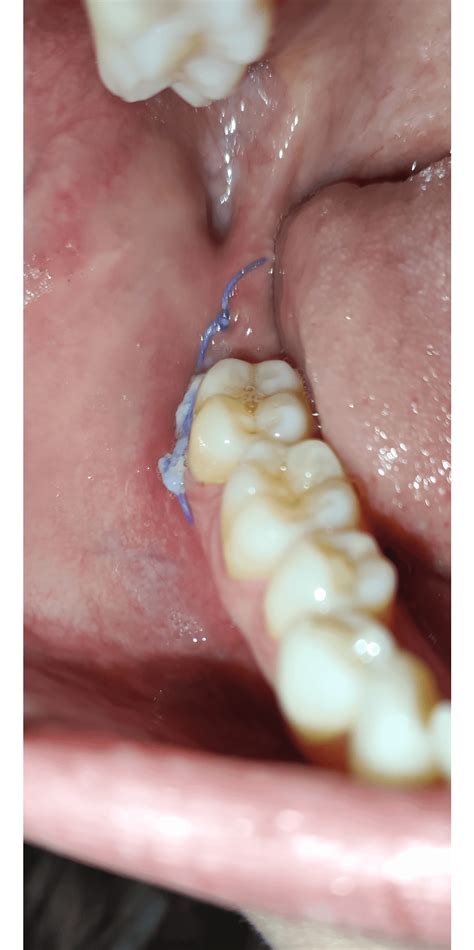 3 Weeks After Operation They Told Me The Stitches Are Absorbable The Lasts Days The Stitches