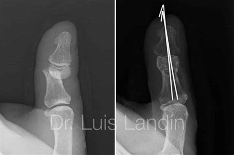 Fractura De Falange Dedo Dr Landín Dr Thione