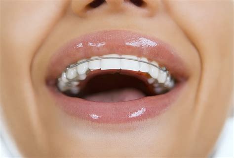 How Long Do I Wear My Retainer After Braces Projects Linguistics